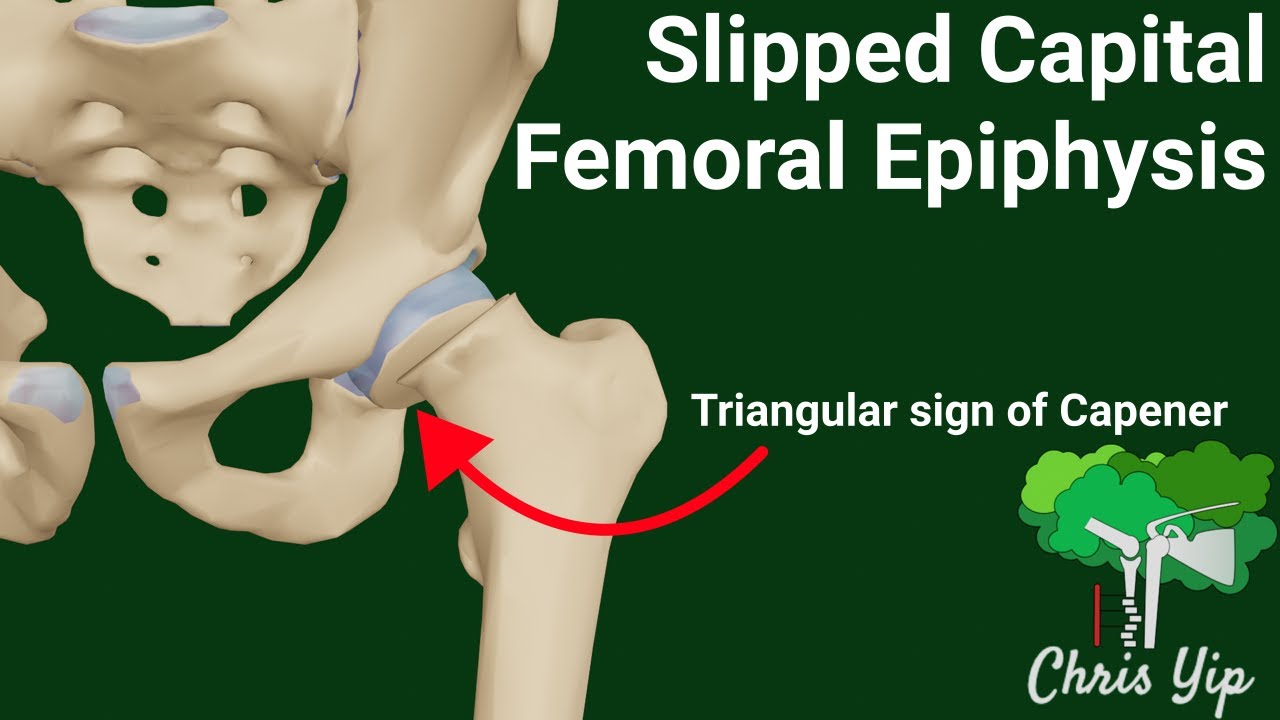 Slipped Capital Femoral Epiphysis + X-Rays Explained (Animated) - YouTube