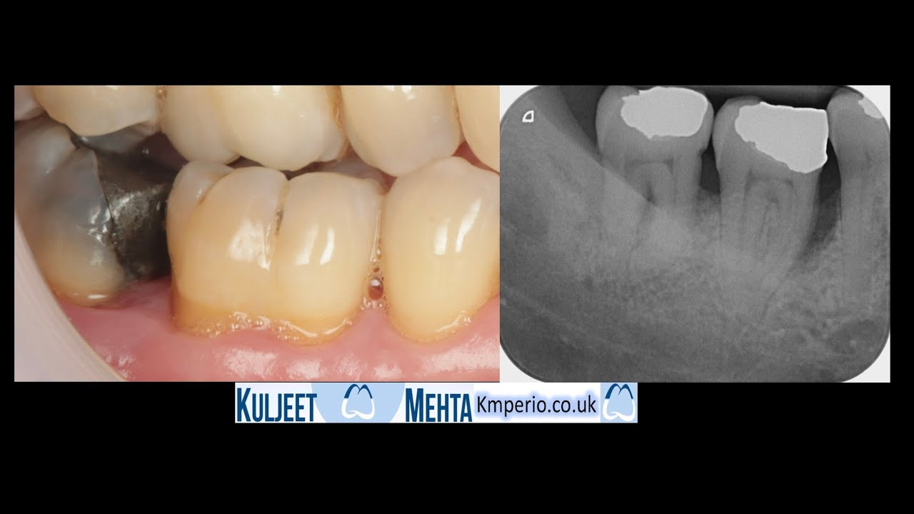 Periodontal surgery lower right molars with Emdogain & Allograft. - YouTube