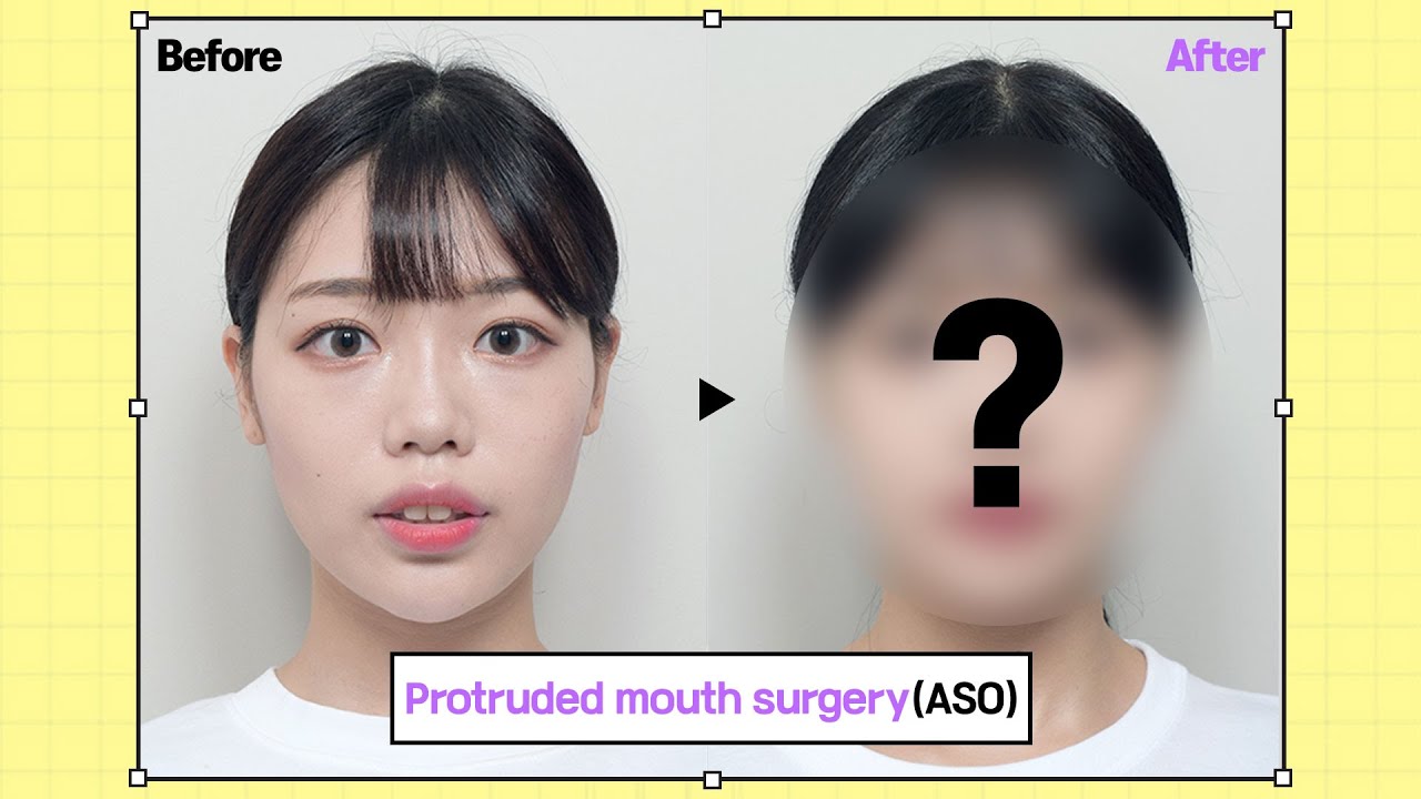Female Protruded mouth surgery Before & After | Post OP 6Months 突出口手術 ...