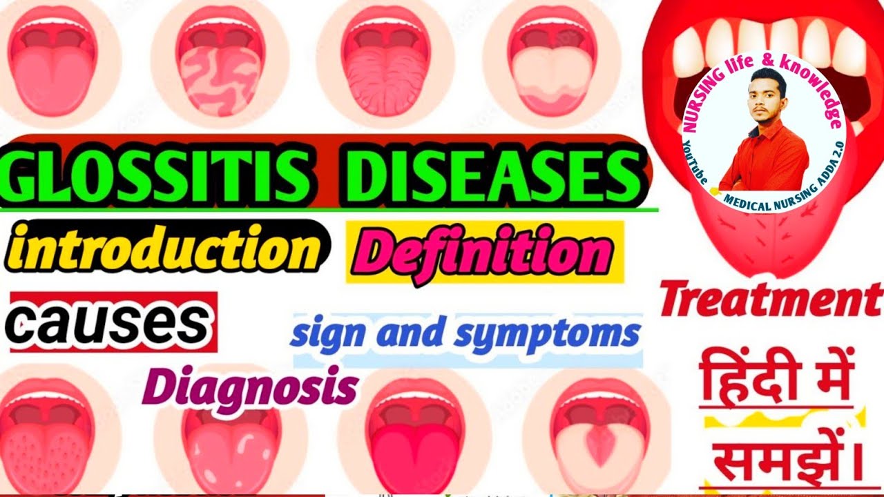 glossitis/glossitis in hindi/glossitis disease /glossitis: causes,sign ...