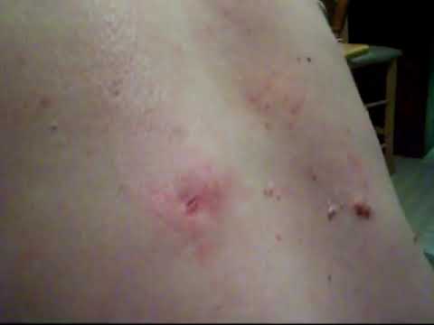 zit abcess cyst???whopper explosion on back - YouTube
