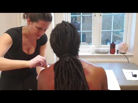 Kerokan or Gua Sha treatment 2018 for neck and back pain by Jacina a London based TCM therapist