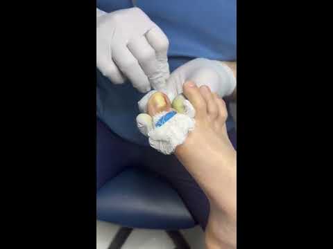 MATRICECTOMIA! Solución definitiva para uñas encarnadas! - YouTube