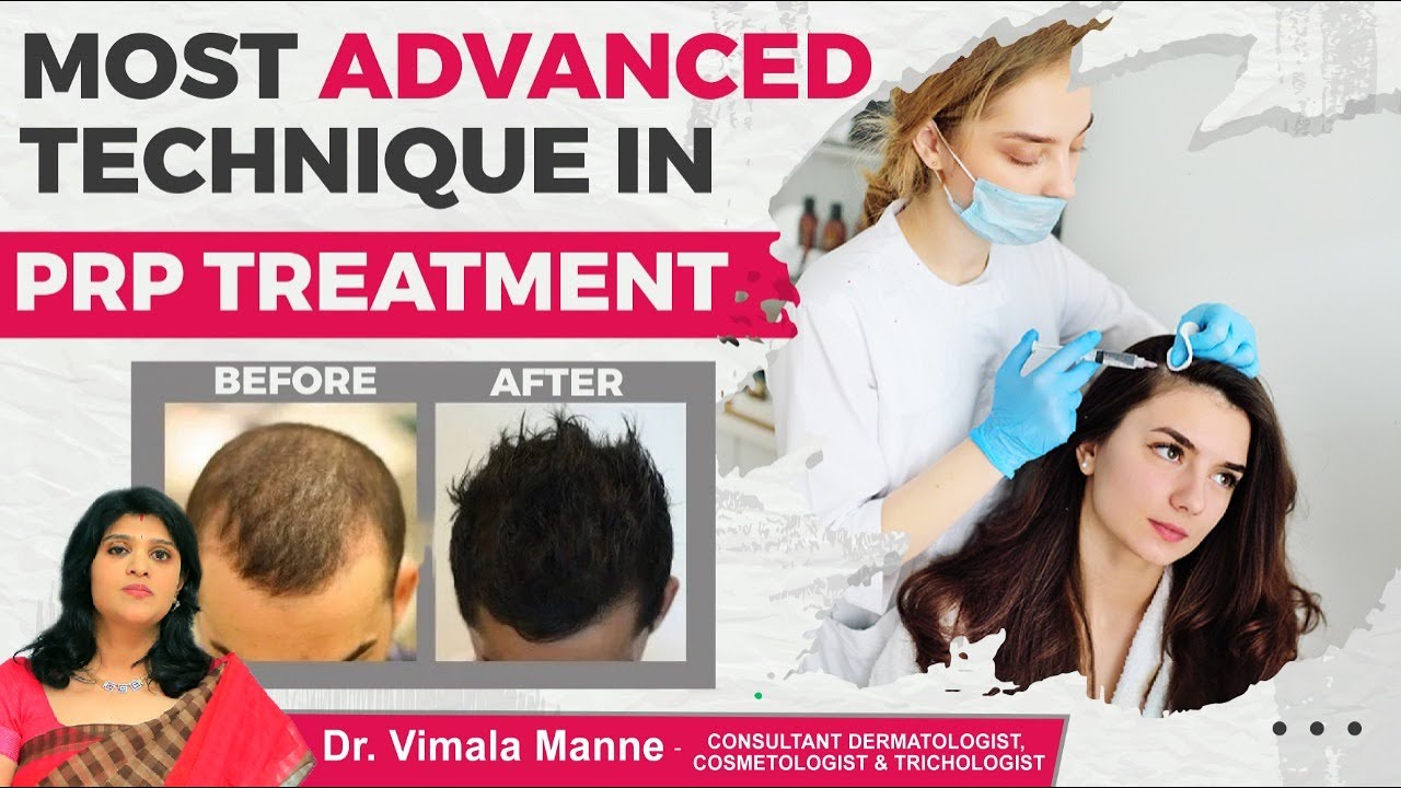 Platelet Rich Plasma for Hair Loss | PRP Hair Loss Treatment | Dr ...