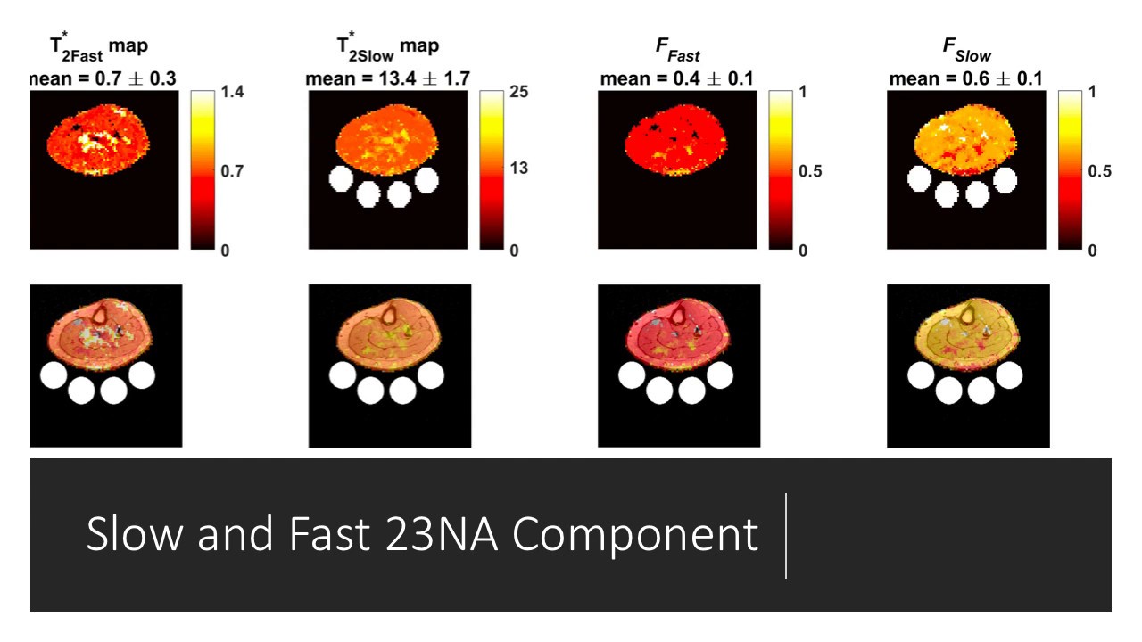 23NA Sodium Magnetic Resonance Spectroscopic Imaging, MRSI, Multi-Echo ...