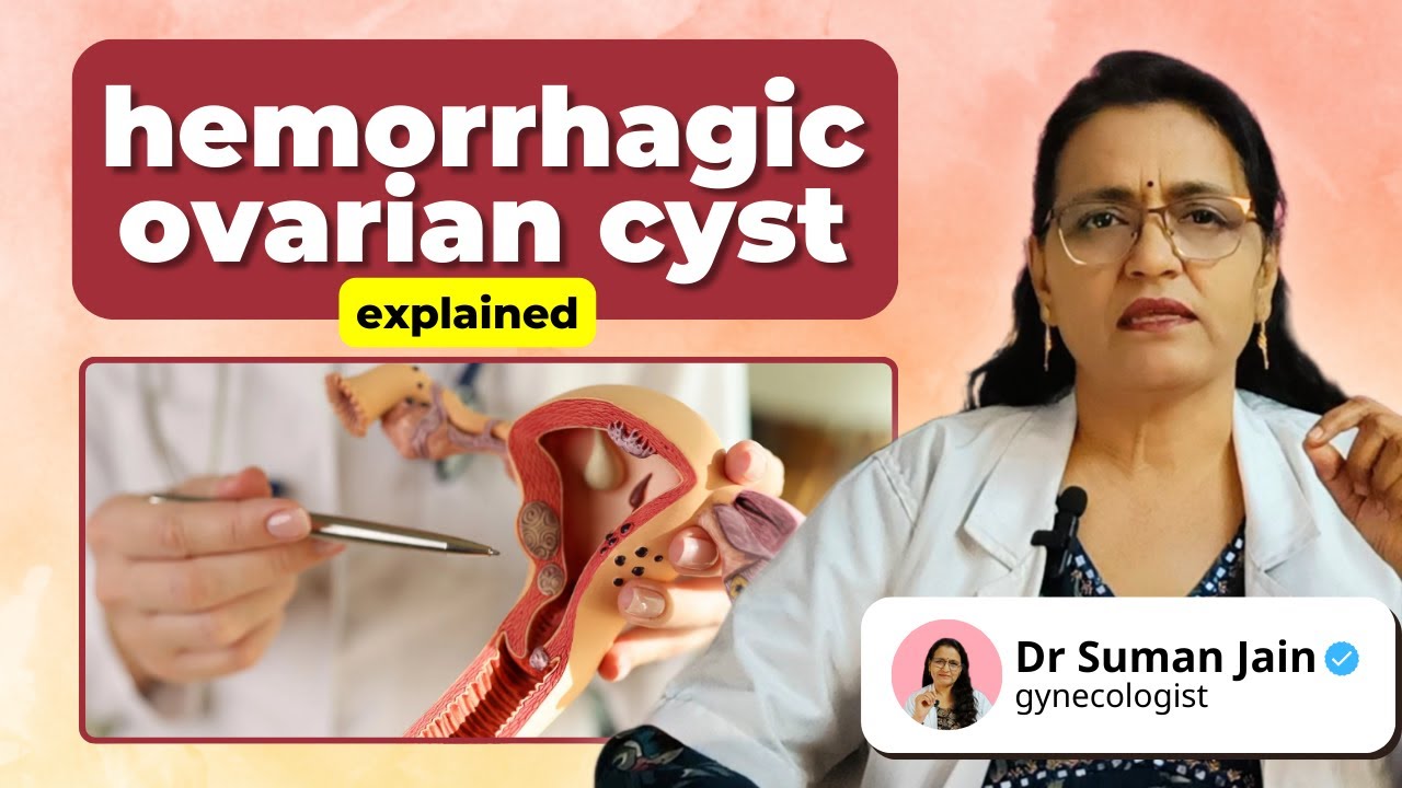Hemorrhagic Ovarian Cyst: Symptoms, Causes & Treatment | Dr. Suman Jain ...