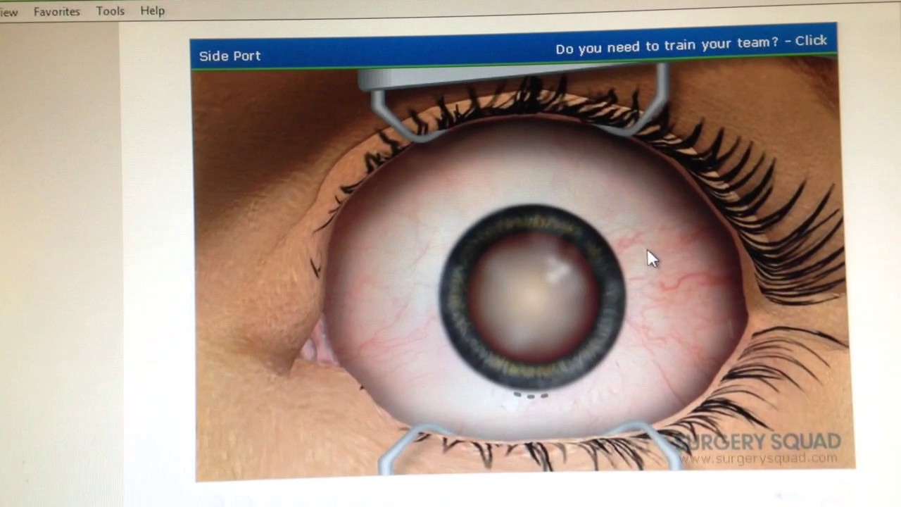 I HATE NEEDLES! | Cataract Eye Surgery/Surgery Squad.com - YouTube