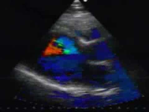 Hypertrophic cardiomyopathy echo case by dr Chatziathanasiou - YouTube