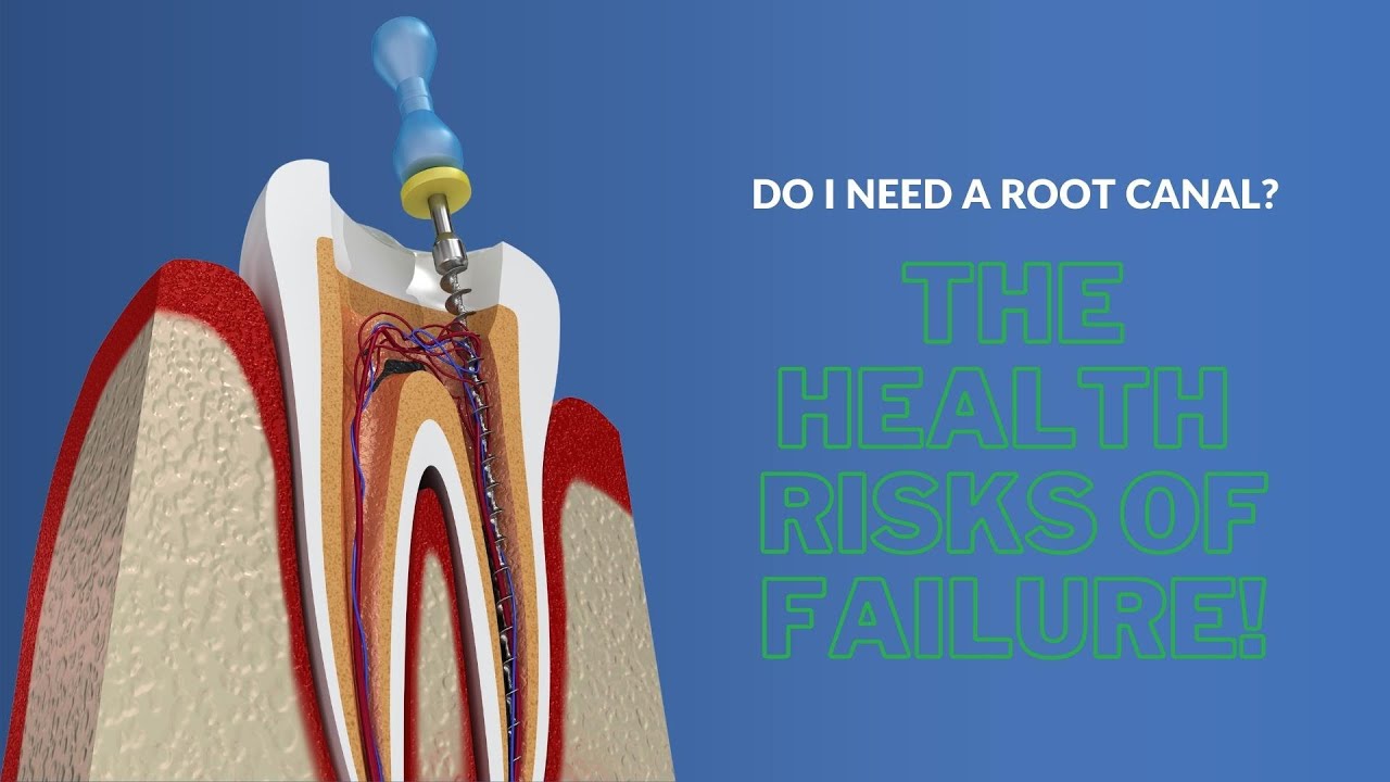 Are Root Canals Bad For Your Health YouTube are-root-canals-bad-for-your-health-youtube