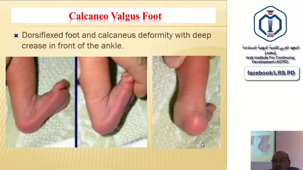 Common pediatric foot / Clinical practice of pediatric orthopedic Prof ...