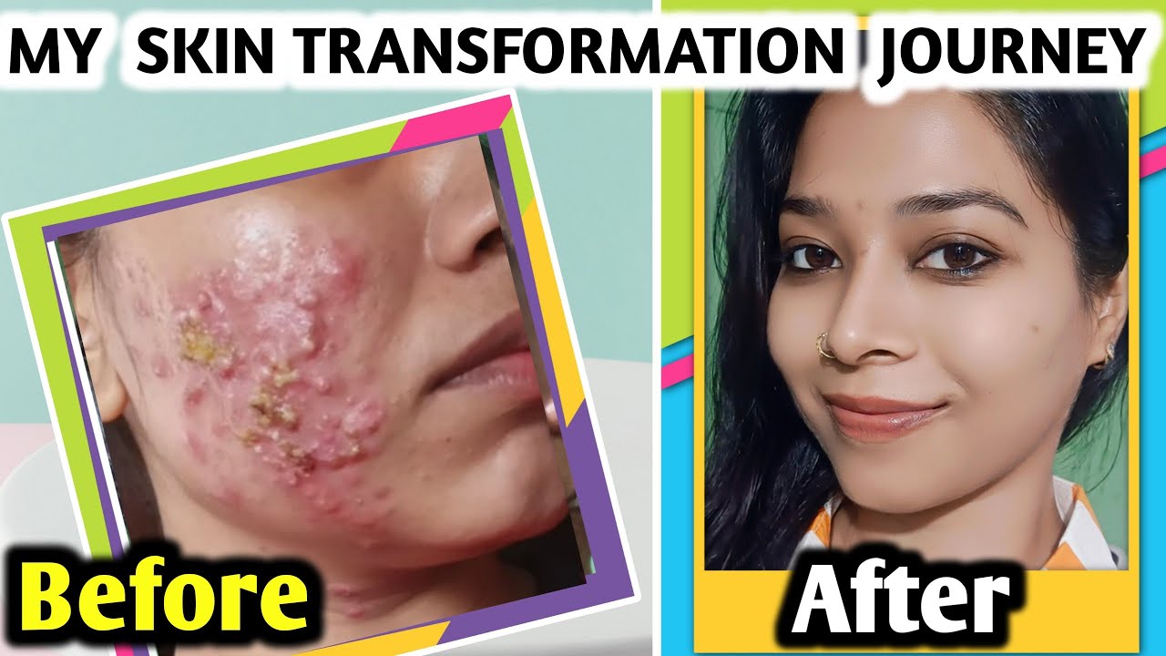 My Skin Transformation after & Before l My Acne Journey l How Treated ...