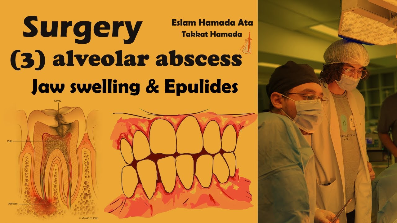 (3) Surgery | alveolar abscess | Jaw swelling (Epulides) - YouTube