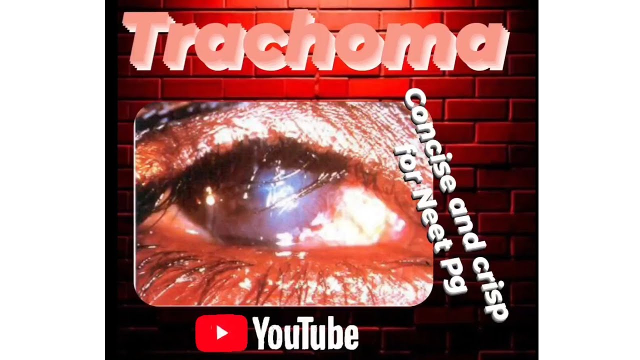 trachoma | trachoma lecture ophthalmology | Concise and crisp for ...