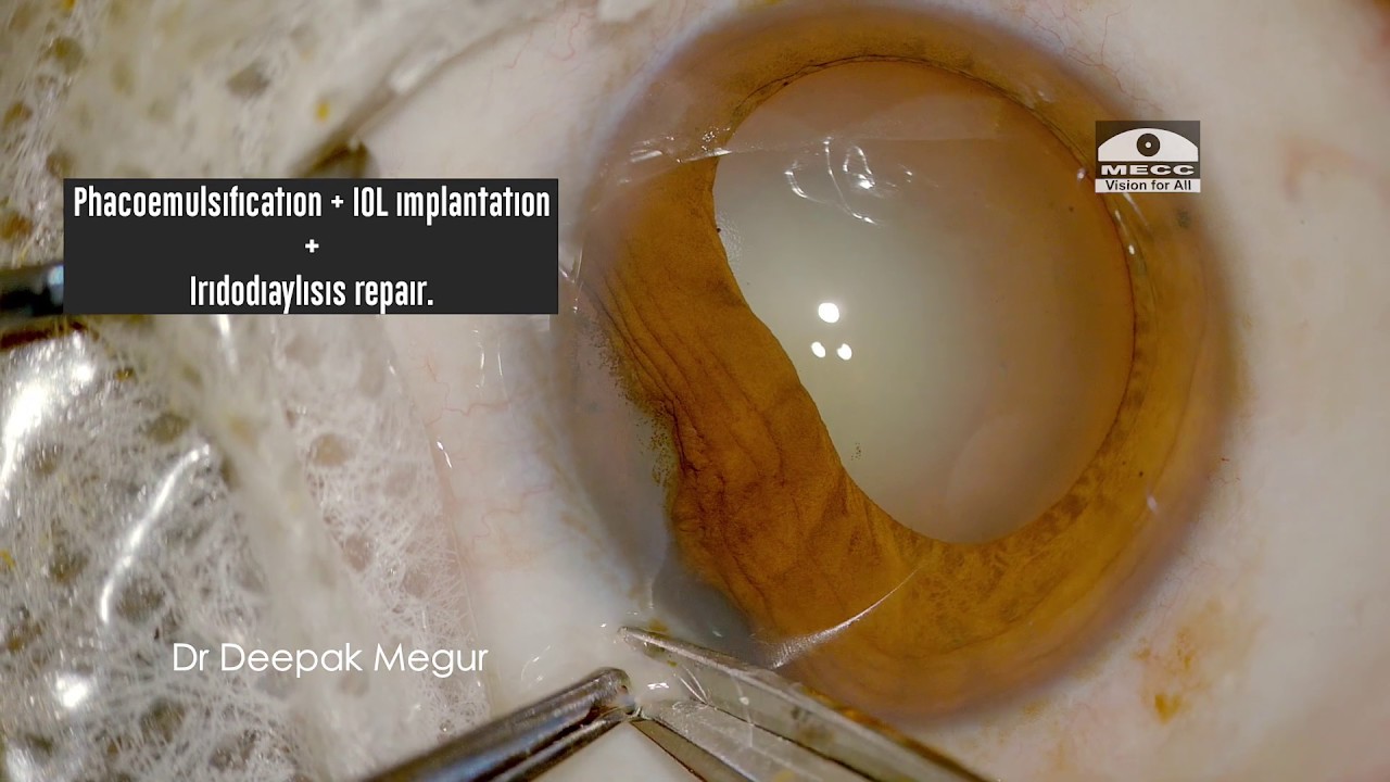 Iridodialysis repair along with cataract surgery ( Phaco). Dr Deepak ...