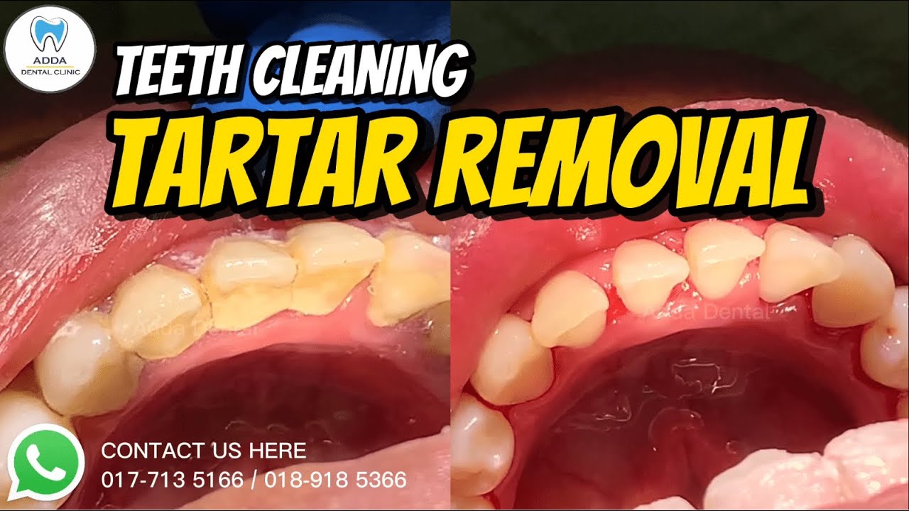 Teeth Cleaning Tartar Removal | Satisfying | Cuci Gigi | Scaling ...