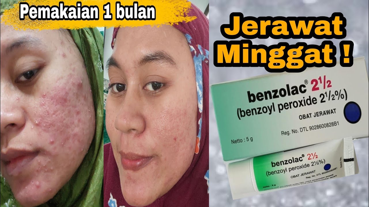 CARA PAKAI OBAT JERAWAT BENZOLAC PEROXIDE YANG BENAR - YouTube