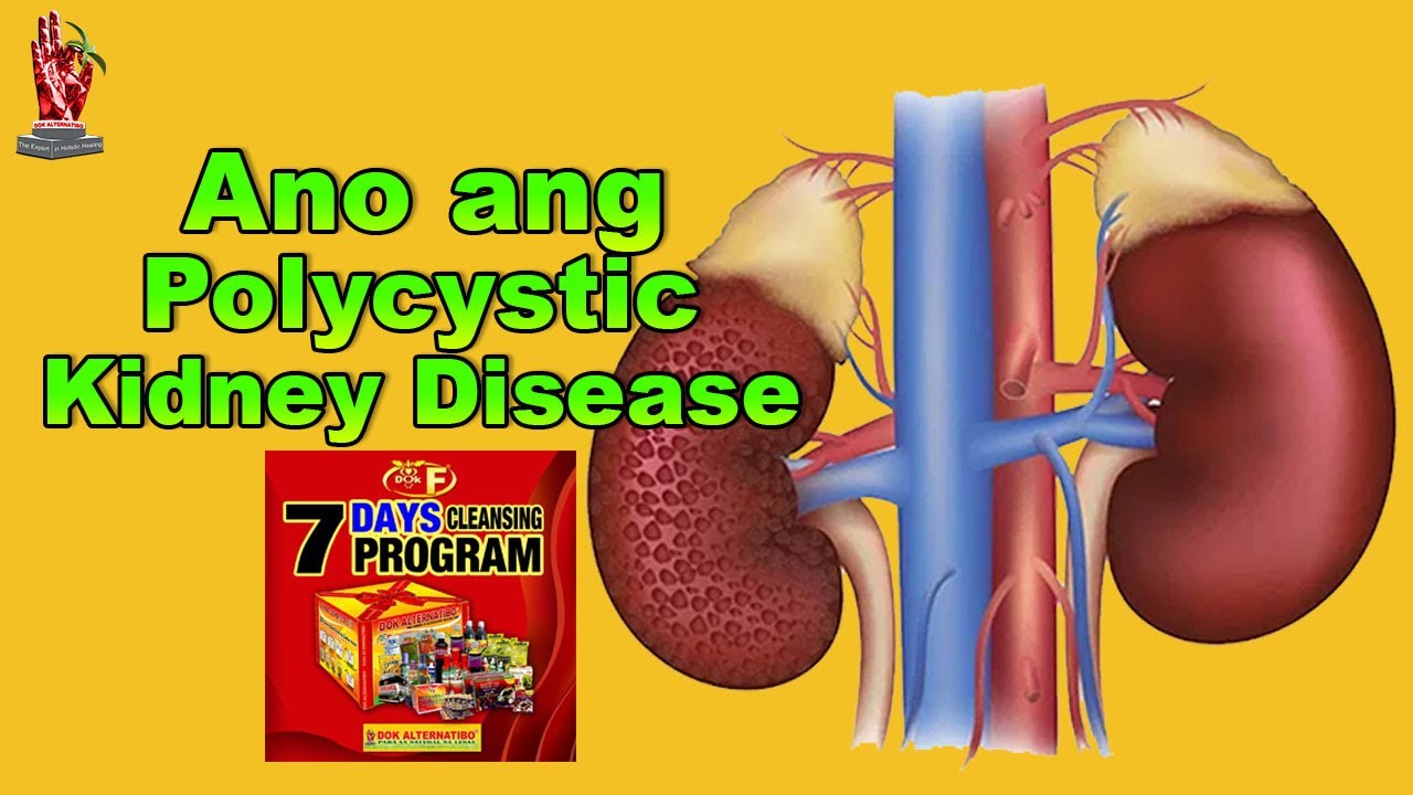 Dok Alternatibo: Paano maagapan ang Polycystic Kidney Disease? - YouTube