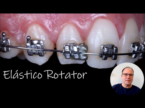 Elástico Rotator - Ortodontia - YouTube