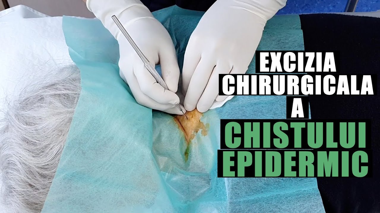 Indepartarea unui CHIST EPIDERMIC - YouTube