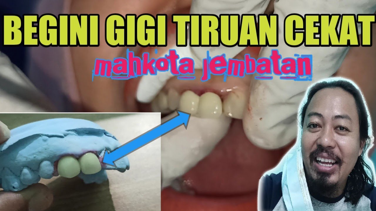 begini proses pemasangan gigi tiruan cekat mahkota jembatan - YouTube