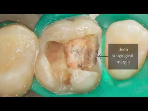 The art of combining direct and indirect composite - Cavity ...