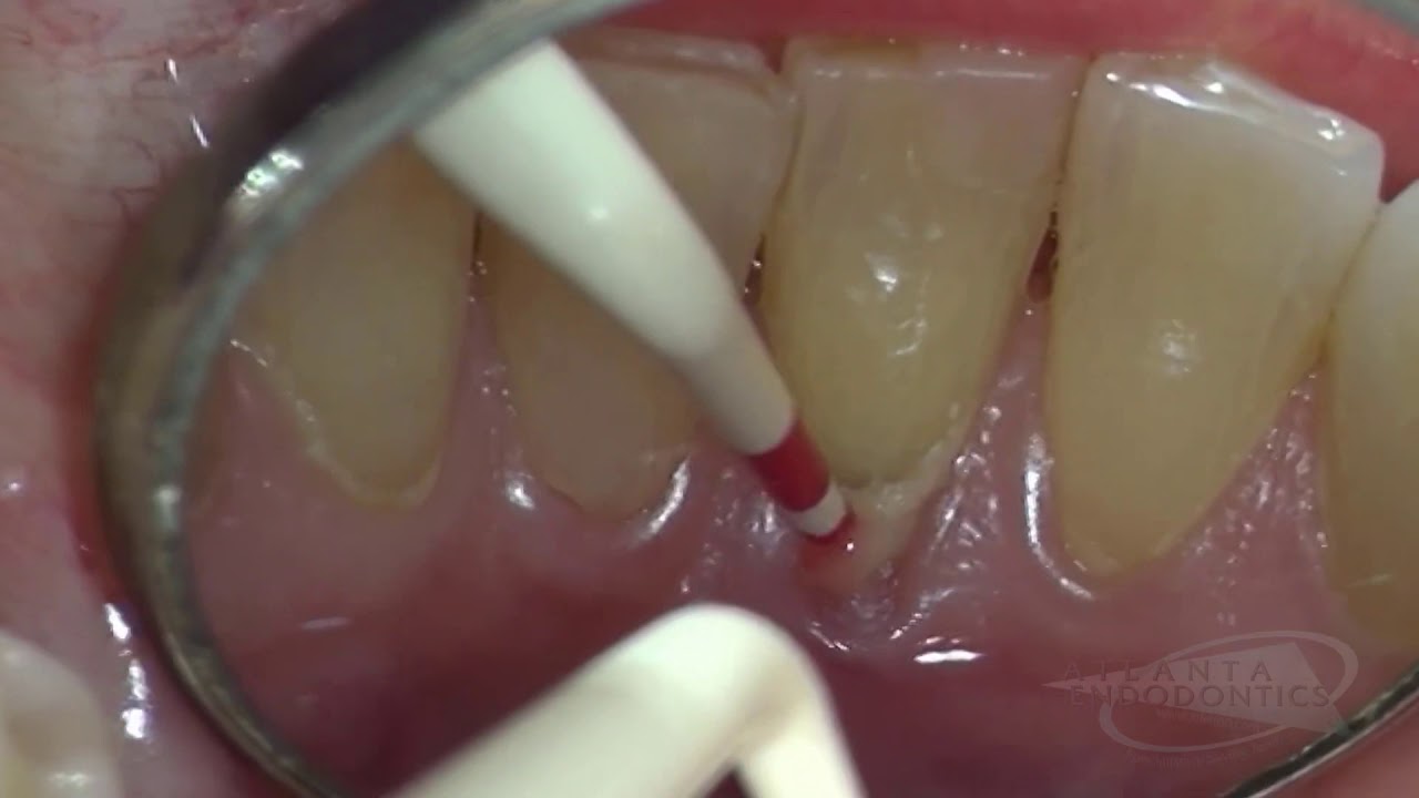 External cervical inflammatory root resorption, ECIR - YouTube