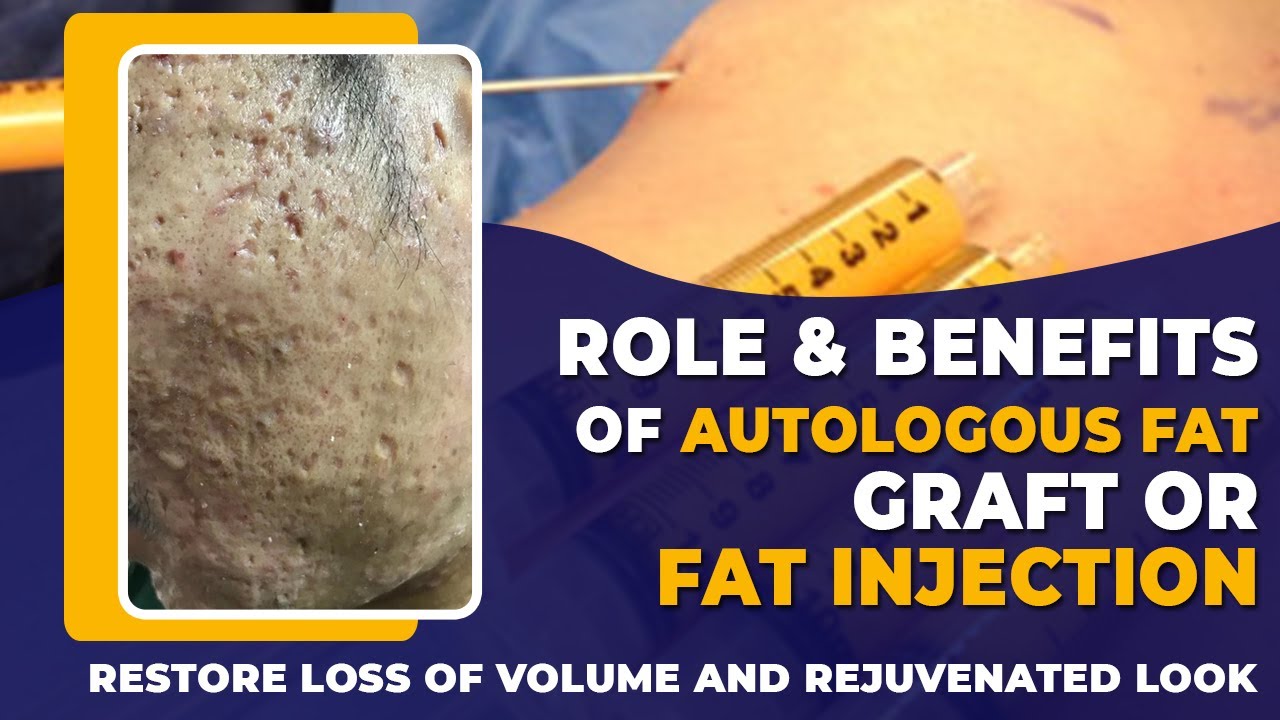 Role & Benefits Of Fat Graft/Fat Injection | Simplify Surgeries With ...