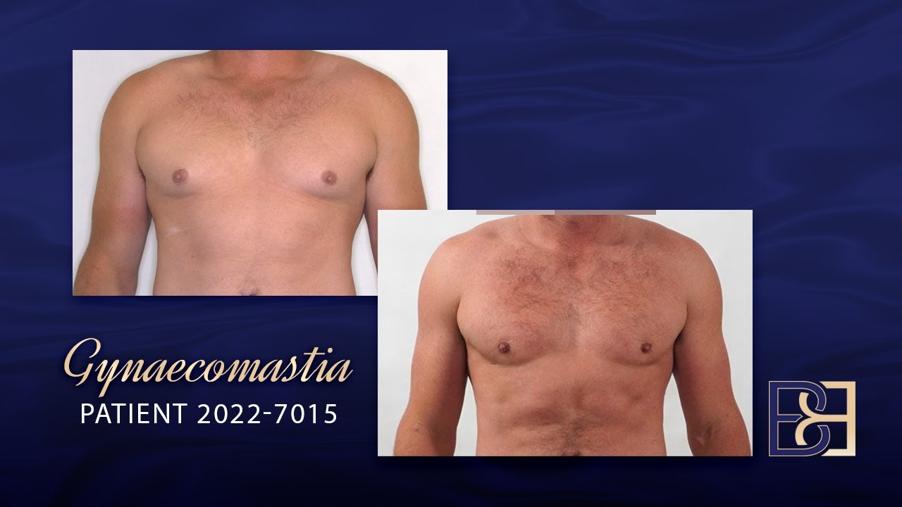 Gynaecomastia Treated with Excision of Gland and VASER Liposuction [BB ...