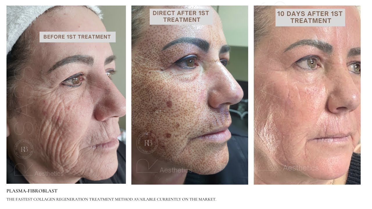 Full Face Plasma Fibroblast | Do’s and Don’ts Every Tech Should Know ...