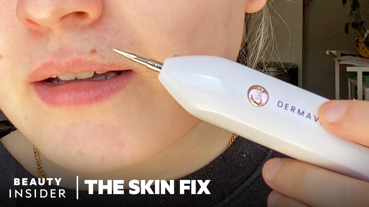 Heated Needle Tool Claims To Remove Skin Tags And Moles At Home | The ...