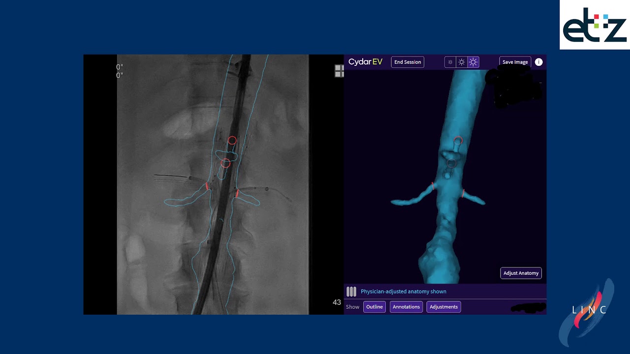 Improve endovascular performance: Comparing Cydar EV with Vessel ...