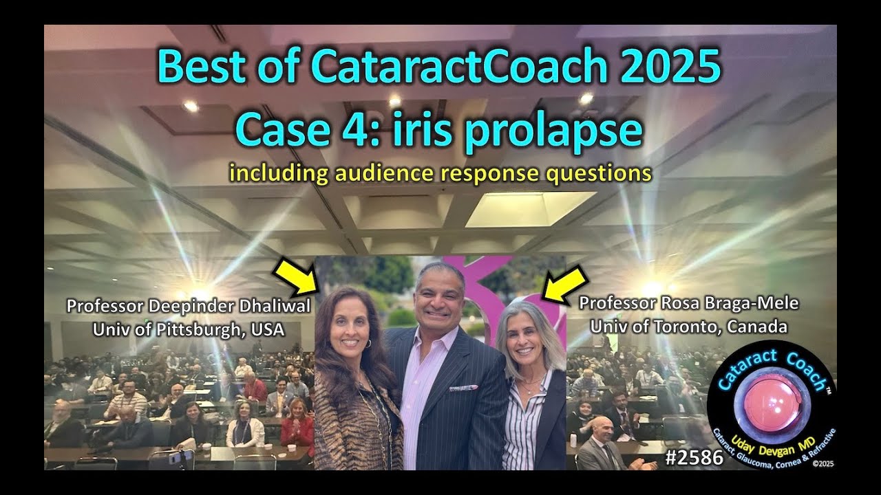 CataractCoach™ 2586: Best of CataractCoach. case 4: iris prolapse - YouTube