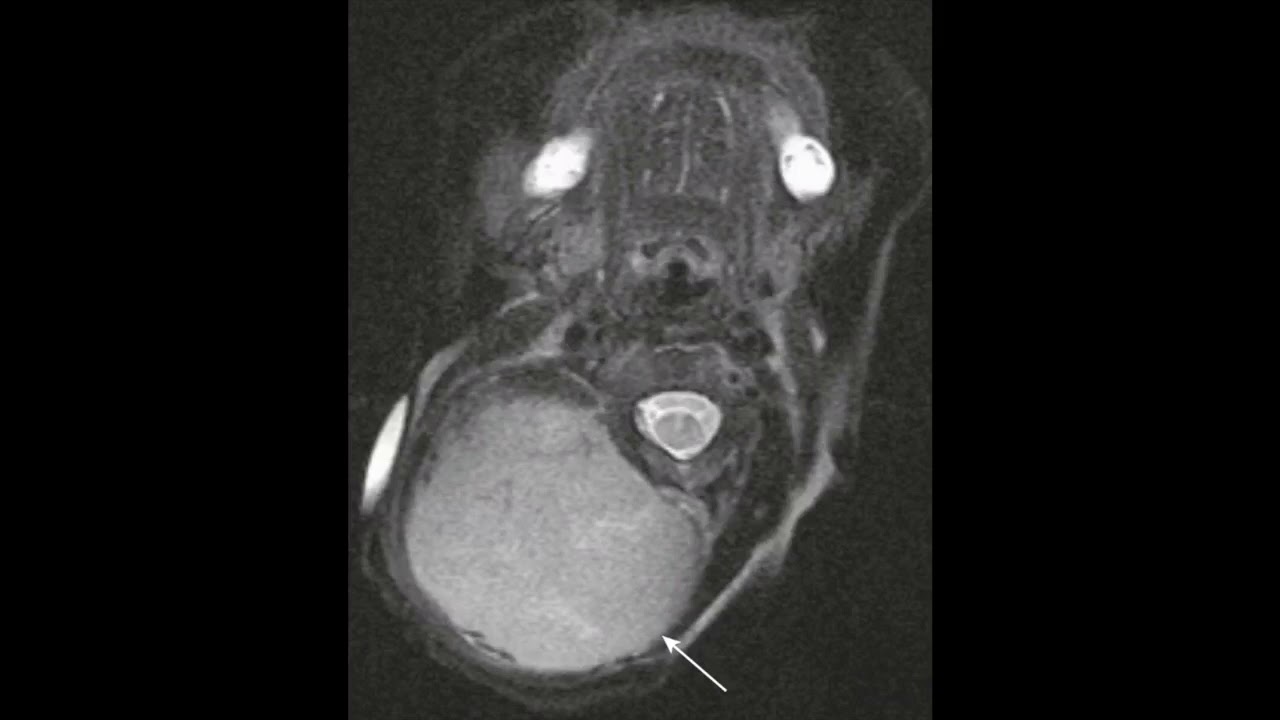 Congenital infantile fibrosarcoma - YouTube