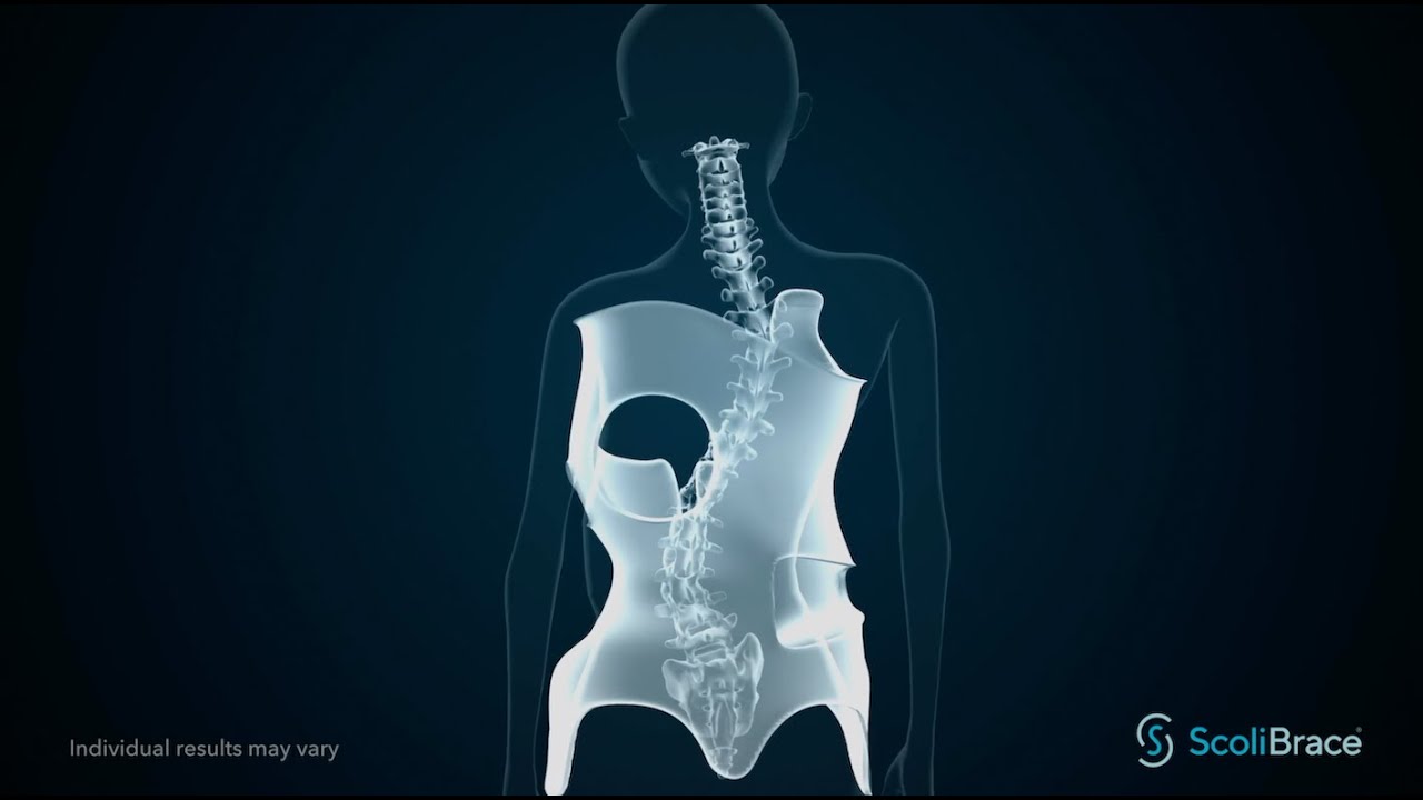 Scoliosis scolibrace for children and adults Dorsi.uk - YouTube