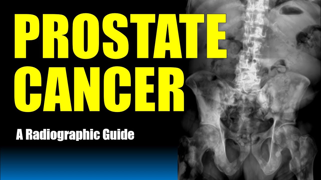 Prostate Cancer Metastasis - A Radiographic Guide #radiology #xray # ...