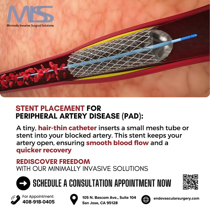 2063 - Stent Peripheral Arterial Disease, Peripheral Vascular Disease ...