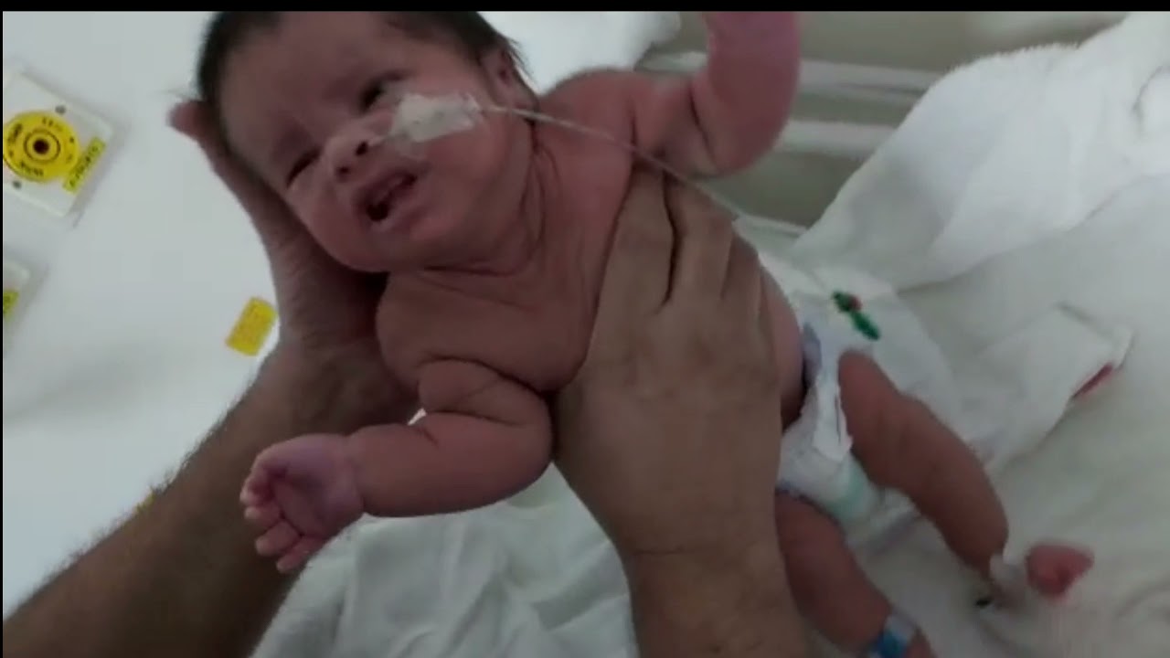 case 598 How to approach for floppy infant? neonatal Hypotonia, head ...