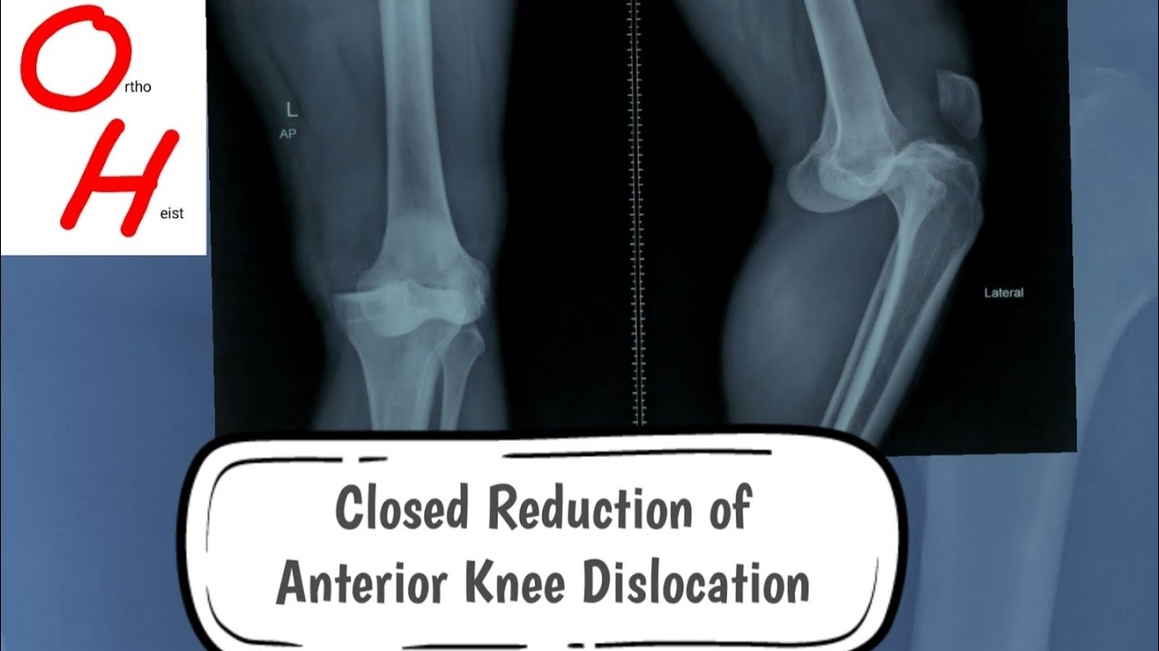 HOW TO REDUCE KNEE DISLOCATION - YouTube