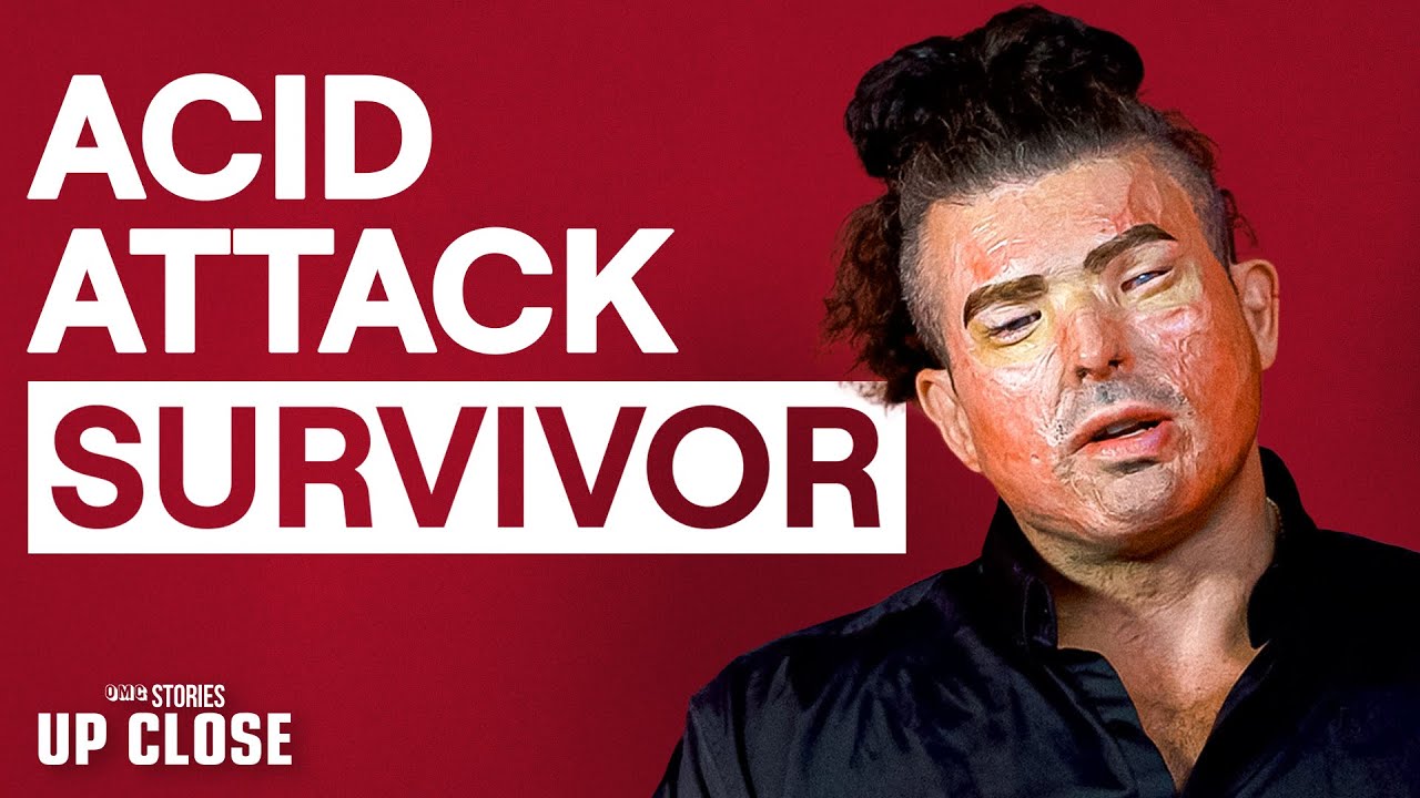 A Pint Of Acid To The Face Changed My Life Forever - YouTube