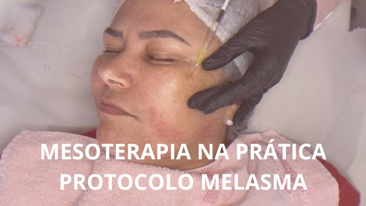Tratamento de melasma. #protocolo #estetica #melasma - YouTube
