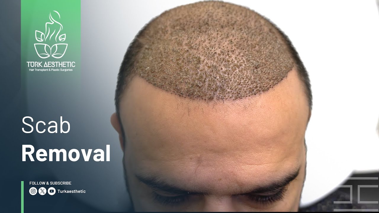 Scab Removal After Hair Transplant (30) Minutes - Turk Aesthetic - YouTube