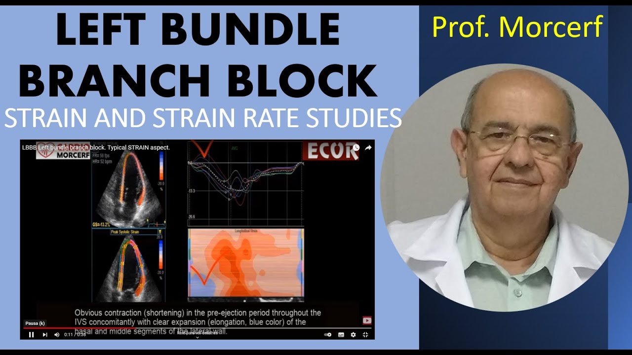 STRAIN ON LEFT BUNDLE BRANCH BLOCK (LBBB) - YouTube