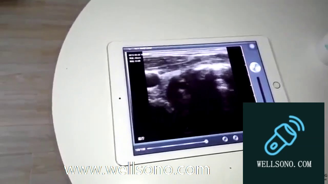 Wireless Portable Ultrasound Mini Scanner Linear Array Probe ...