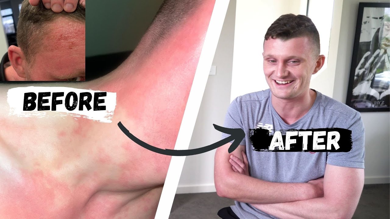 How We CURED Topical Steroid Withdrawal NATURALLY - A TSW Journey ...