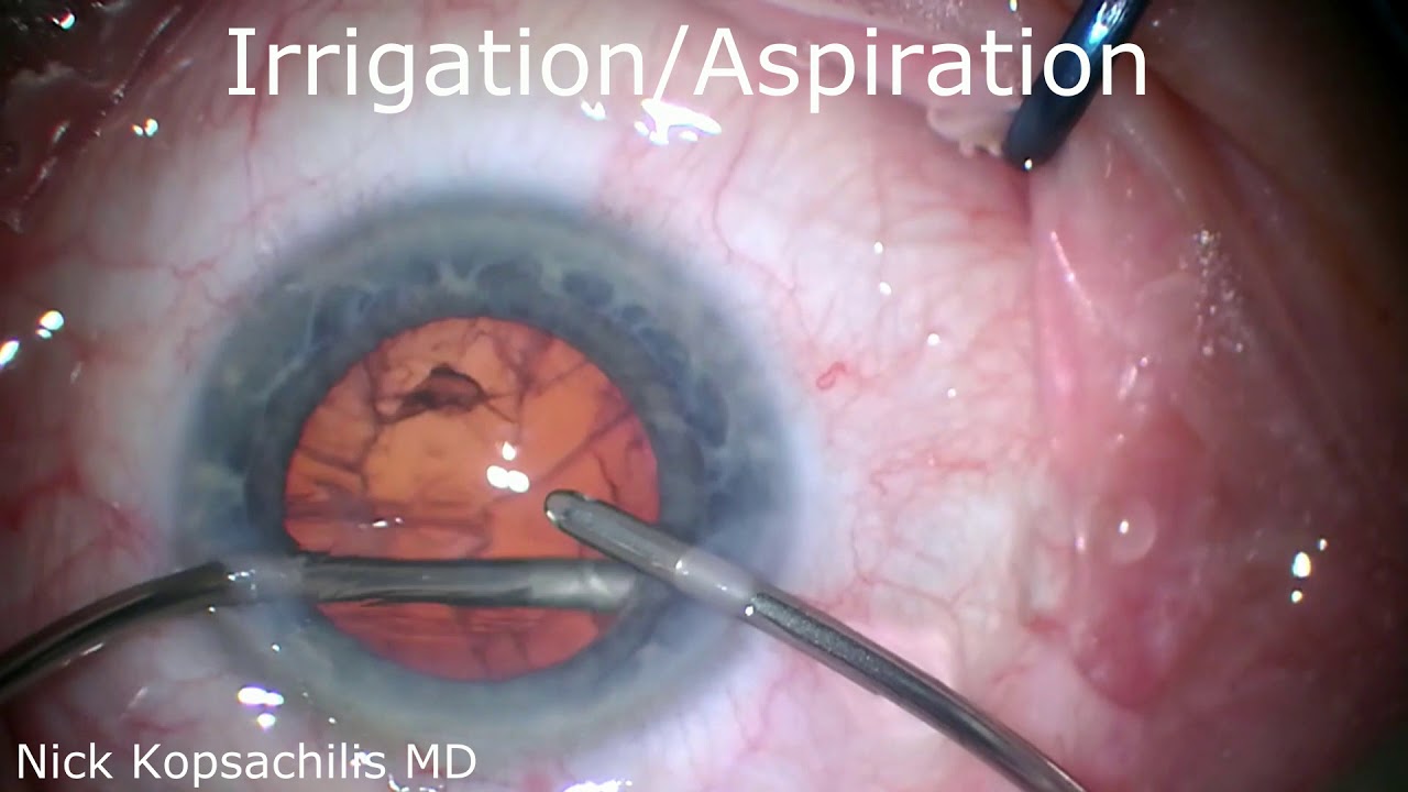 Verion Toric IOL - YouTube