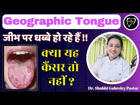 Geographic tongue।। Benign migratory glossitis।। जीभ पर हो रहे धब्बे ...