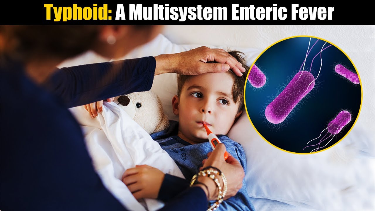 Typhoid Fever: Causes to Cures, and Prevention Strategies - YouTube