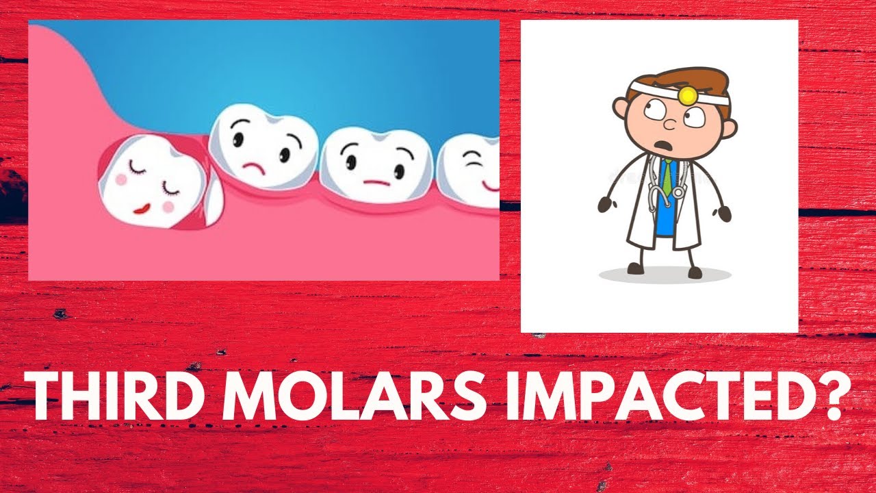 What Are The Factors Associated With Third Molars Impaction? -Oral ...