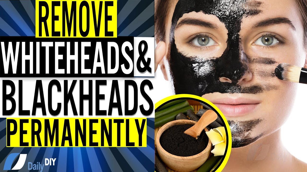 How to Remove Whiteheads Permanently Naturally At Home: Complete ...