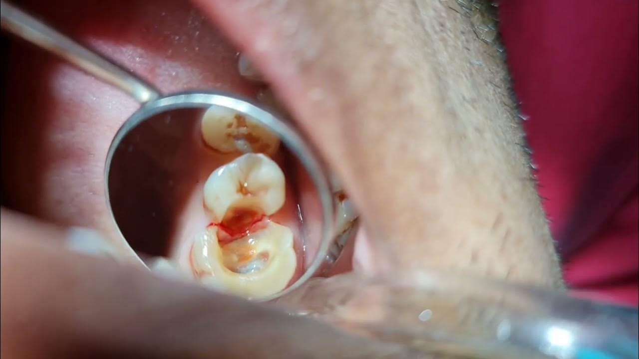 Indirect Pulp Capping(IPC)#HAPPY SMILES#HAPPY DENTISTRY#Dr. DHARMIK ...